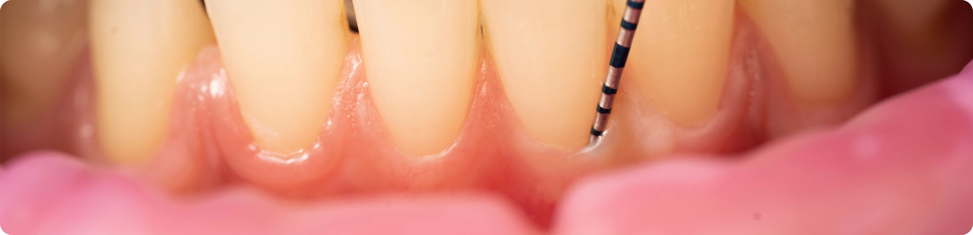 Récession gingivale | Dentistes à Lambersart